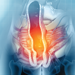 Chronic Hemorrhoids: Symptoms, Causes, Treatment in MN